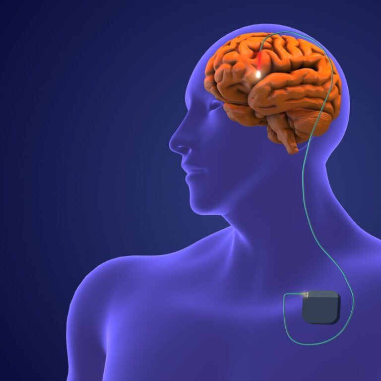 Deep Brain Stimulation Therapy: Overview and Benefits